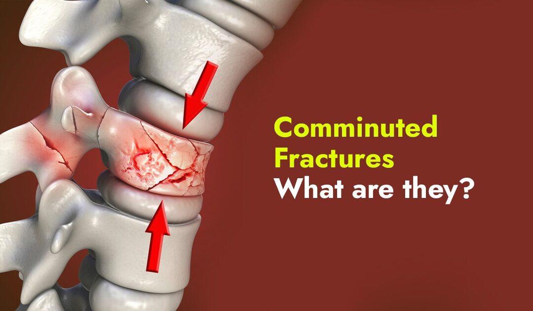 Comminuted Fracture Types, Surgery Procedure and Recovery Pathway