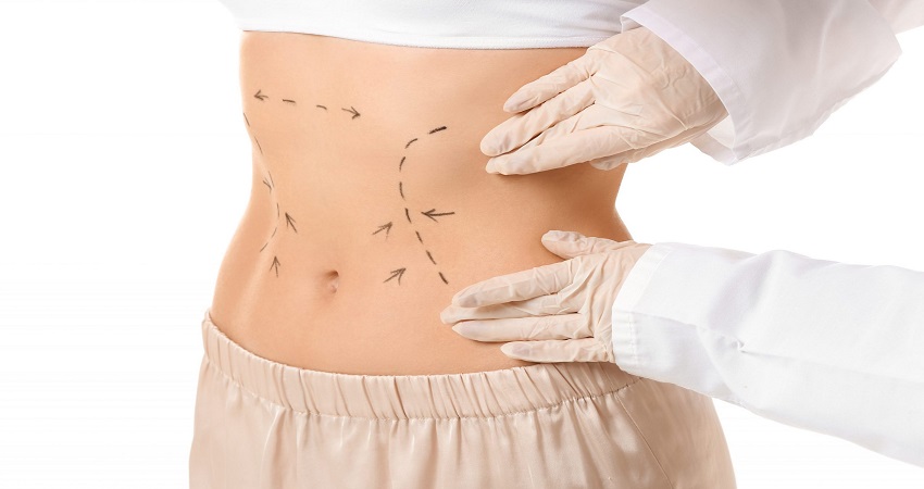 Tummy Tuck in Dubai: Breakdown and Financing Options